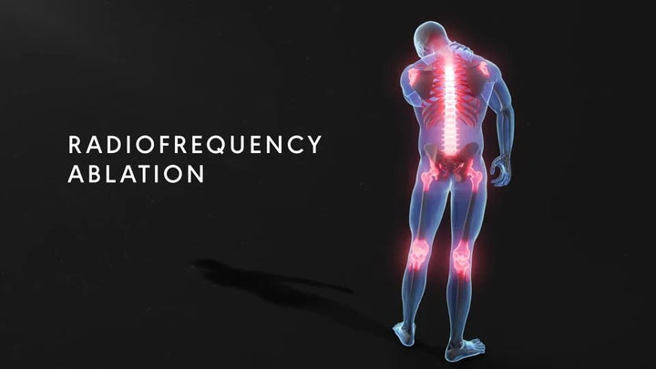 COOLIEF* COOLED RADIOFREQUENCY – Cairo Medical
